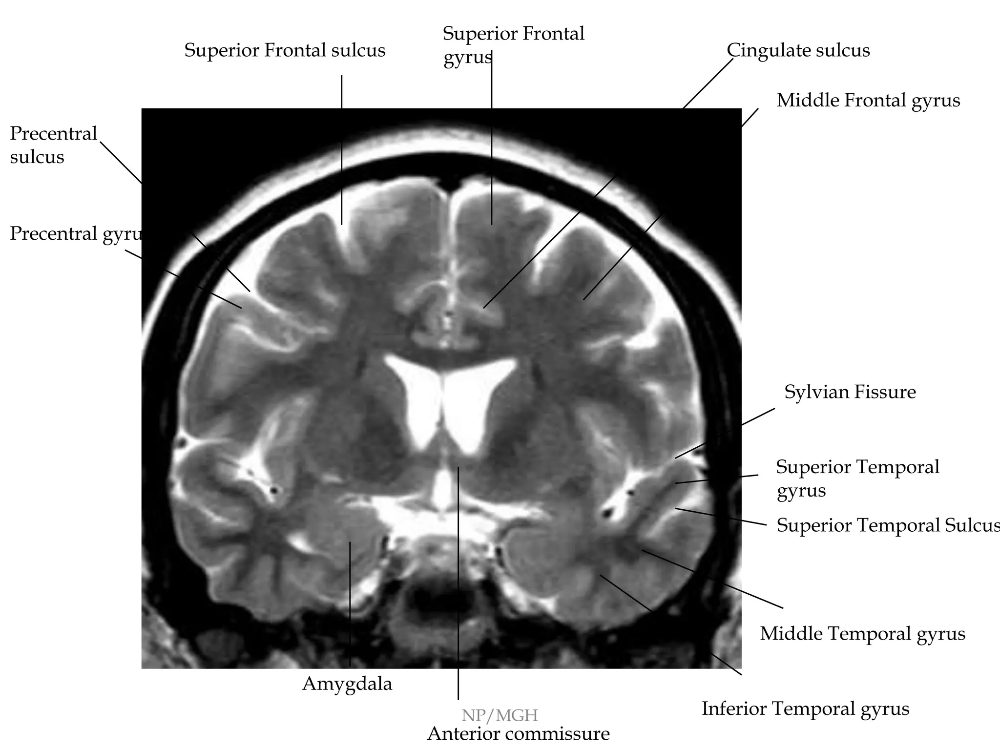Anatomy of brain sulcus and gyrus - Dr.Sajith MD RD | PPTX