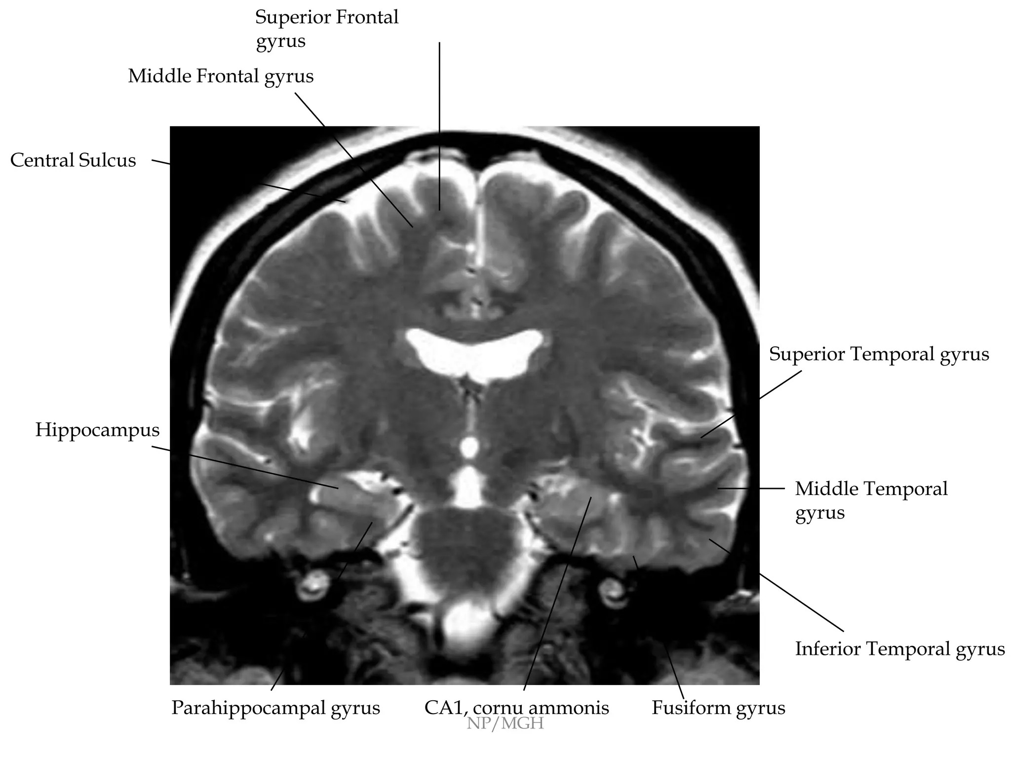 Anatomy of brain sulcus and gyrus - Dr.Sajith MD RD | PPTX