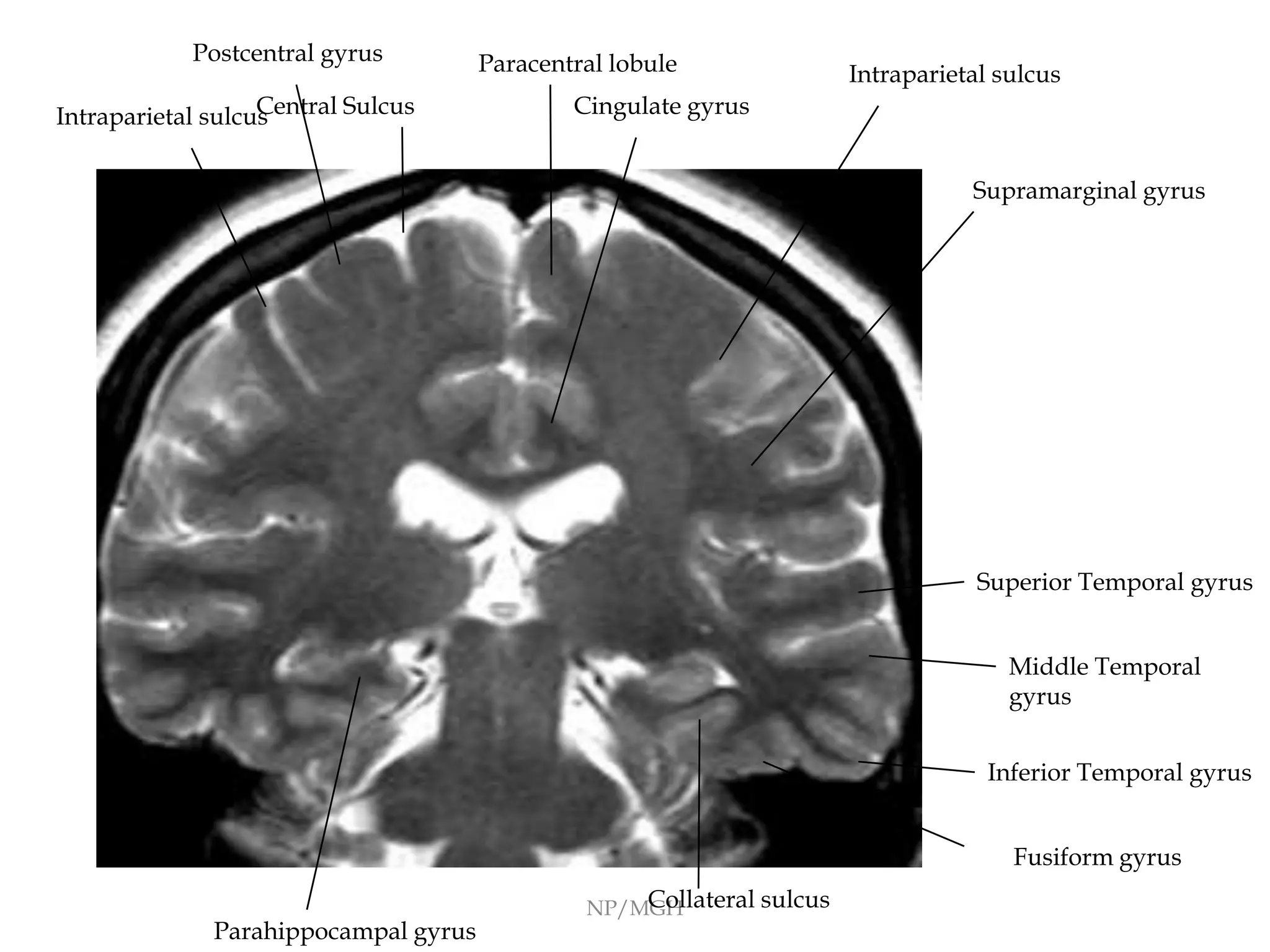 Anatomy of brain sulcus and gyrus - Dr.Sajith MD RD | PPTX