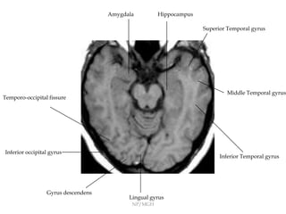 Anatomy of brain sulcus and gyrus - Dr.Sajith MD RD | PPTX