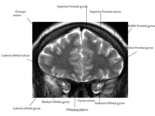 Anatomy of brain sulcus and gyrus - Dr.Sajith MD RD | PPTX