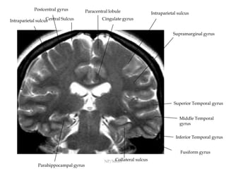 Anatomy of brain sulcus and gyrus - Dr.Sajith MD RD | PPTX