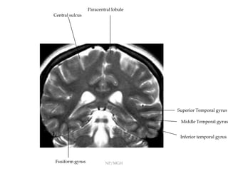 Anatomy of brain sulcus and gyrus - Dr.Sajith MD RD | PPTX | Brain and ...