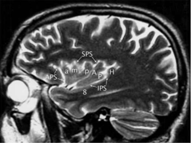 Anatomy of brain sulcus and gyrus - Dr.Sajith MD RD