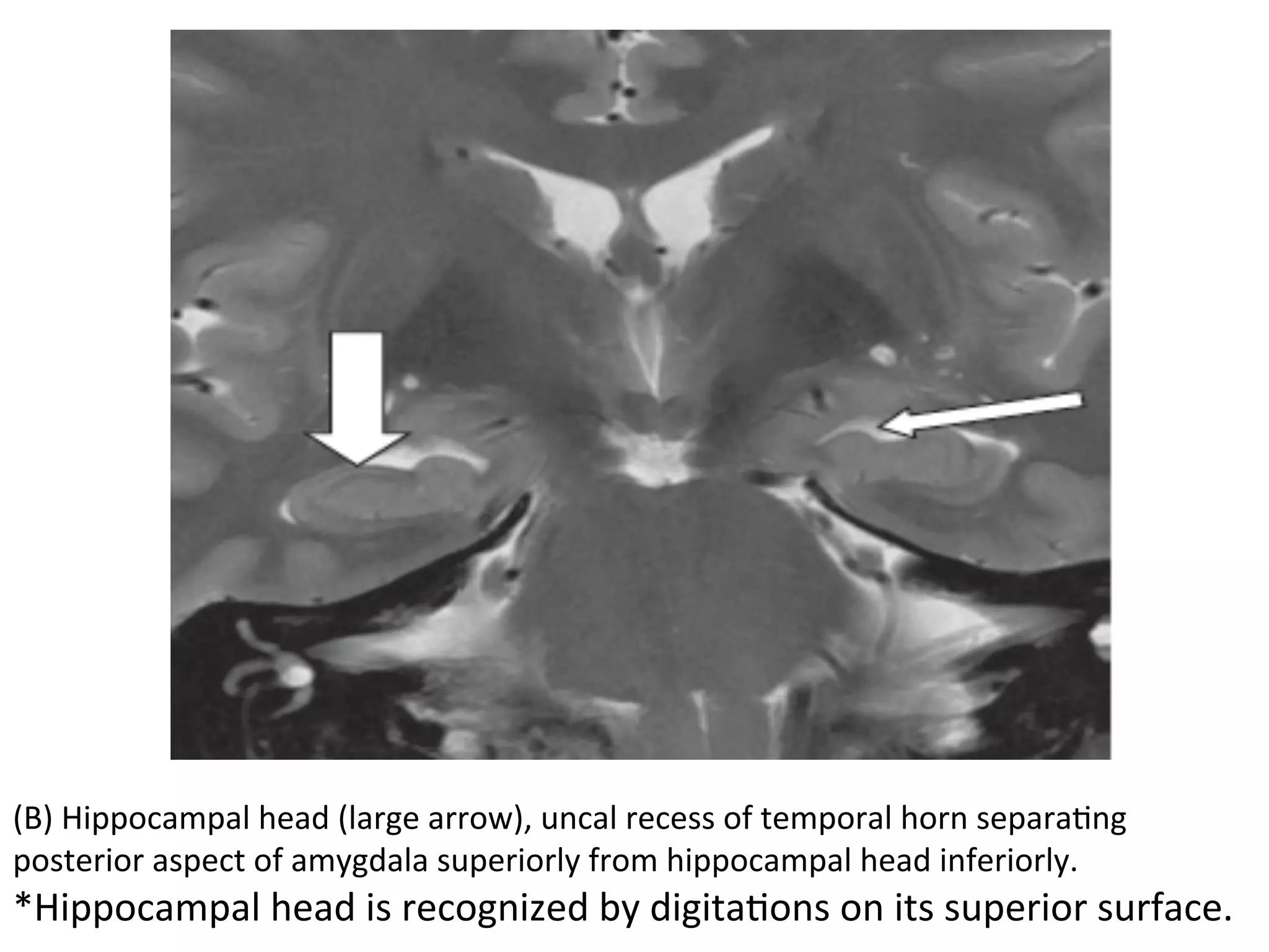 Brain anatomy new | PDF