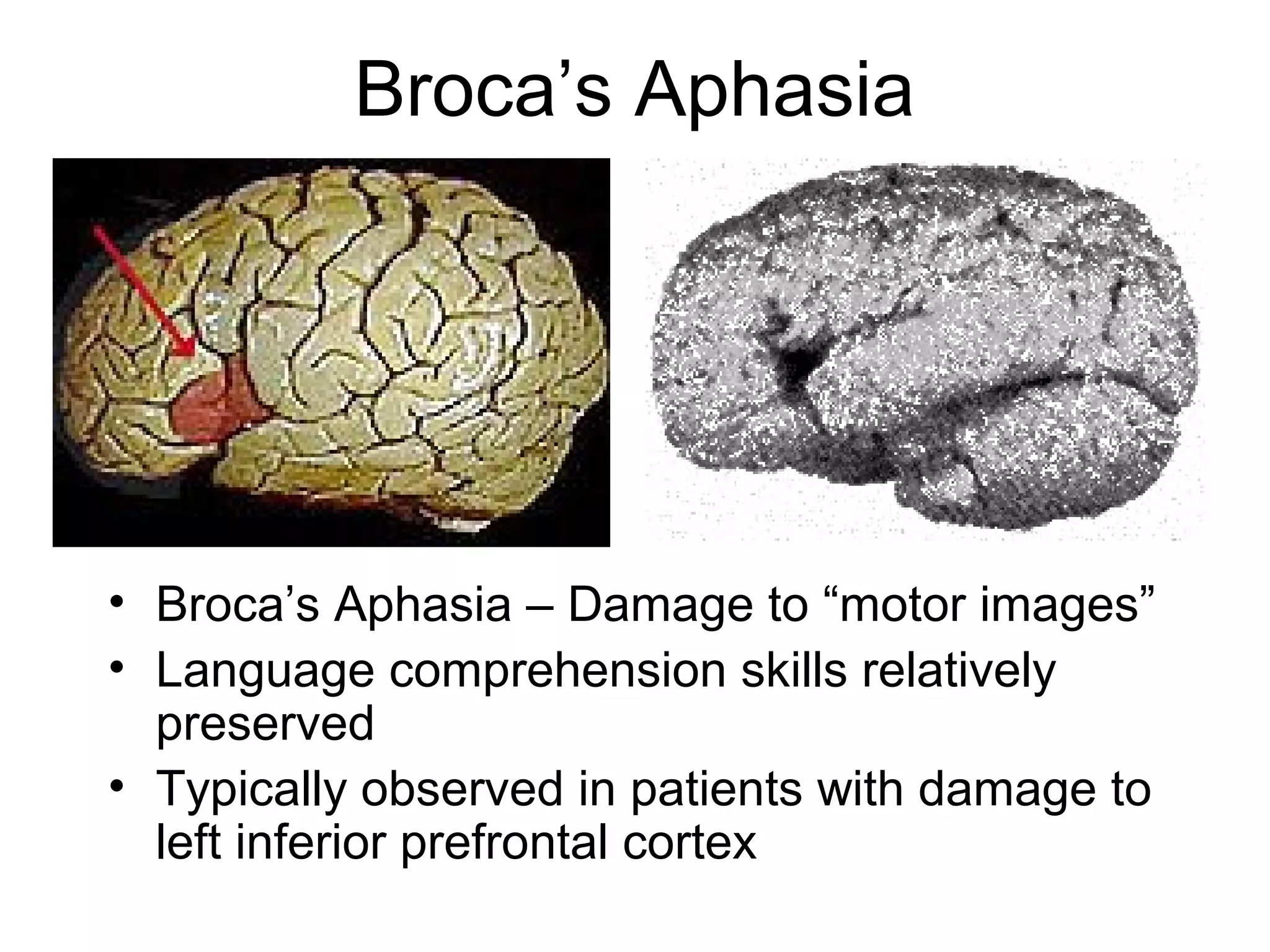 Brain And Aphasia | PPT