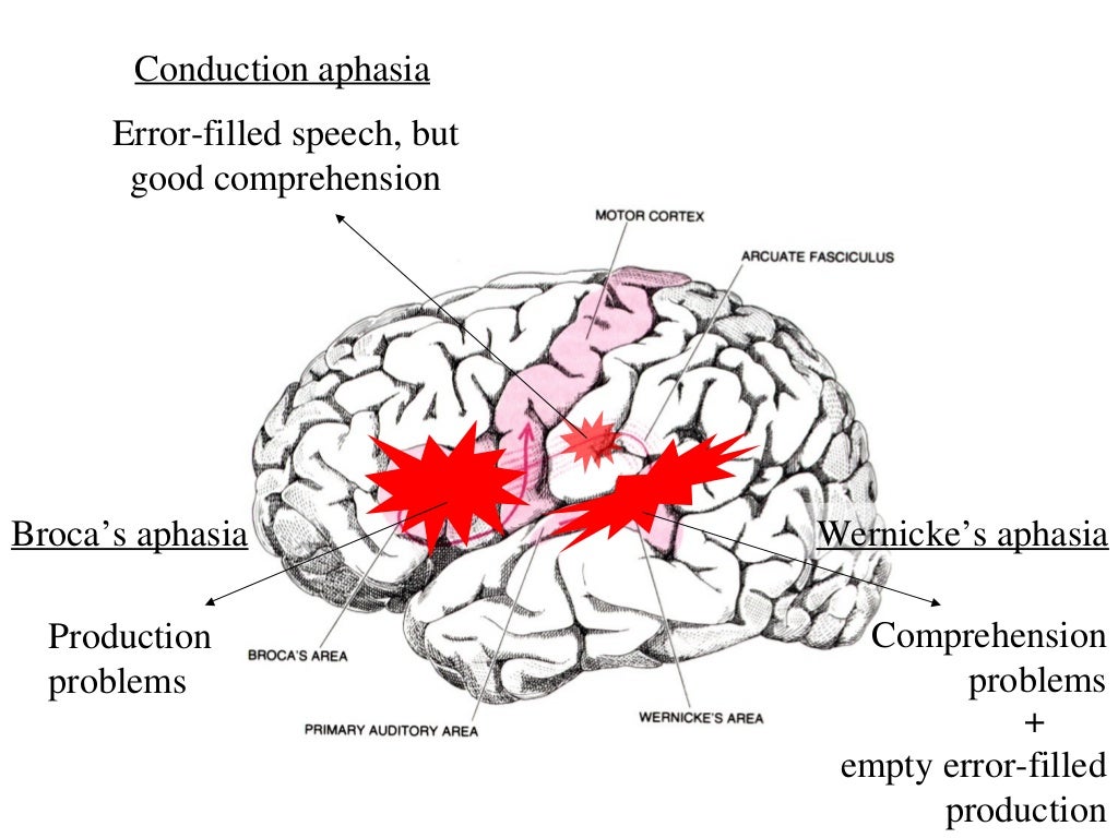 Brain And Aphasia