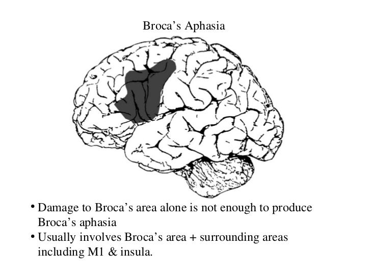 Brain And Aphasia