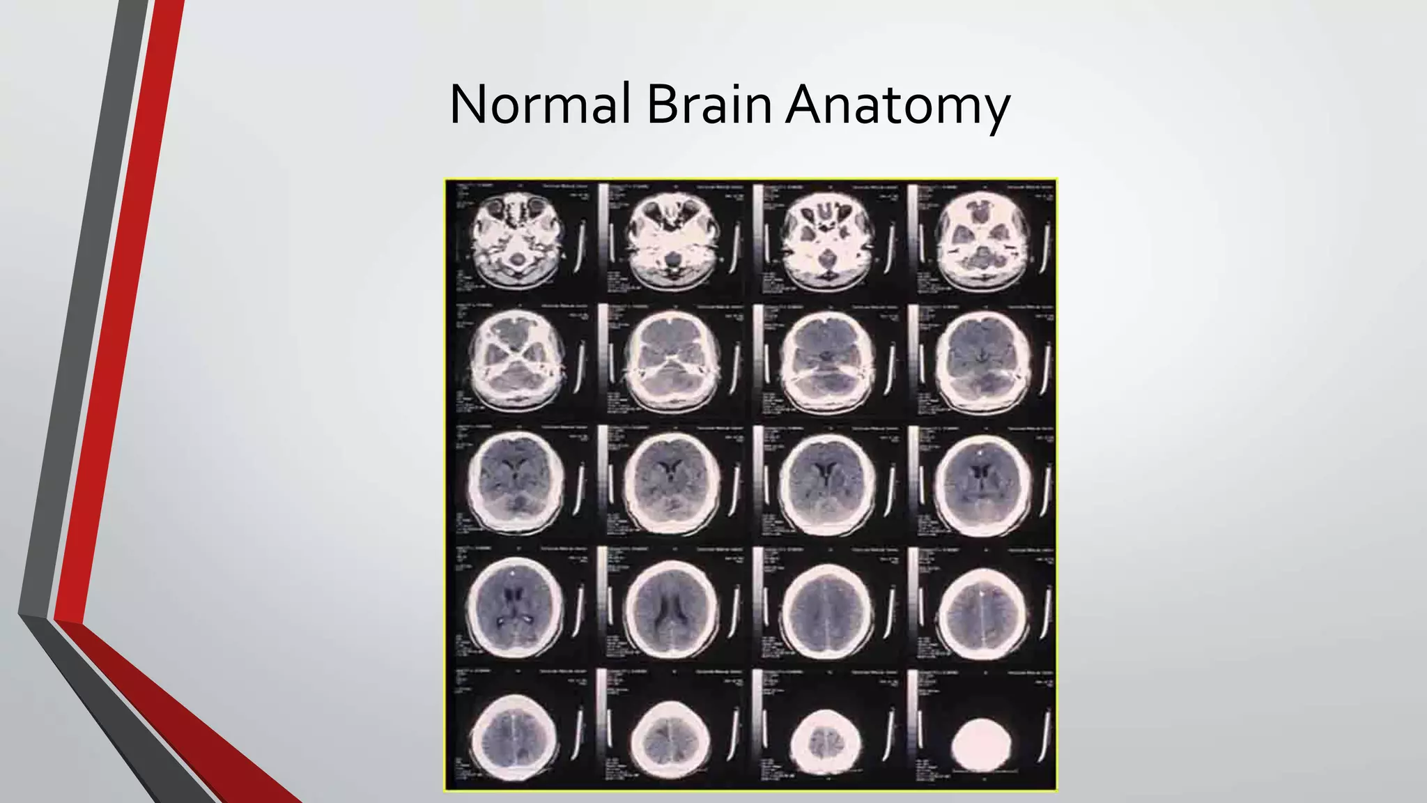 Brain and PNS CT Scan techniques | PPTX