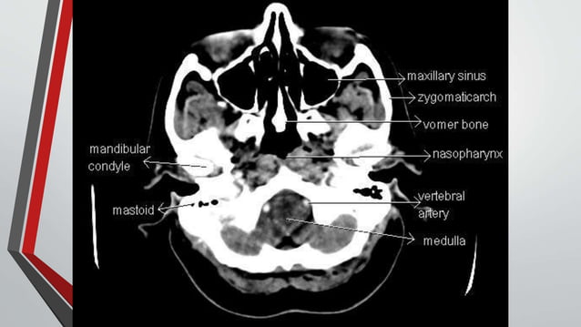 Brain and PNS CT Scan techniques | PPTX