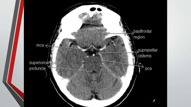 Brain and PNS CT Scan techniques | PPTX