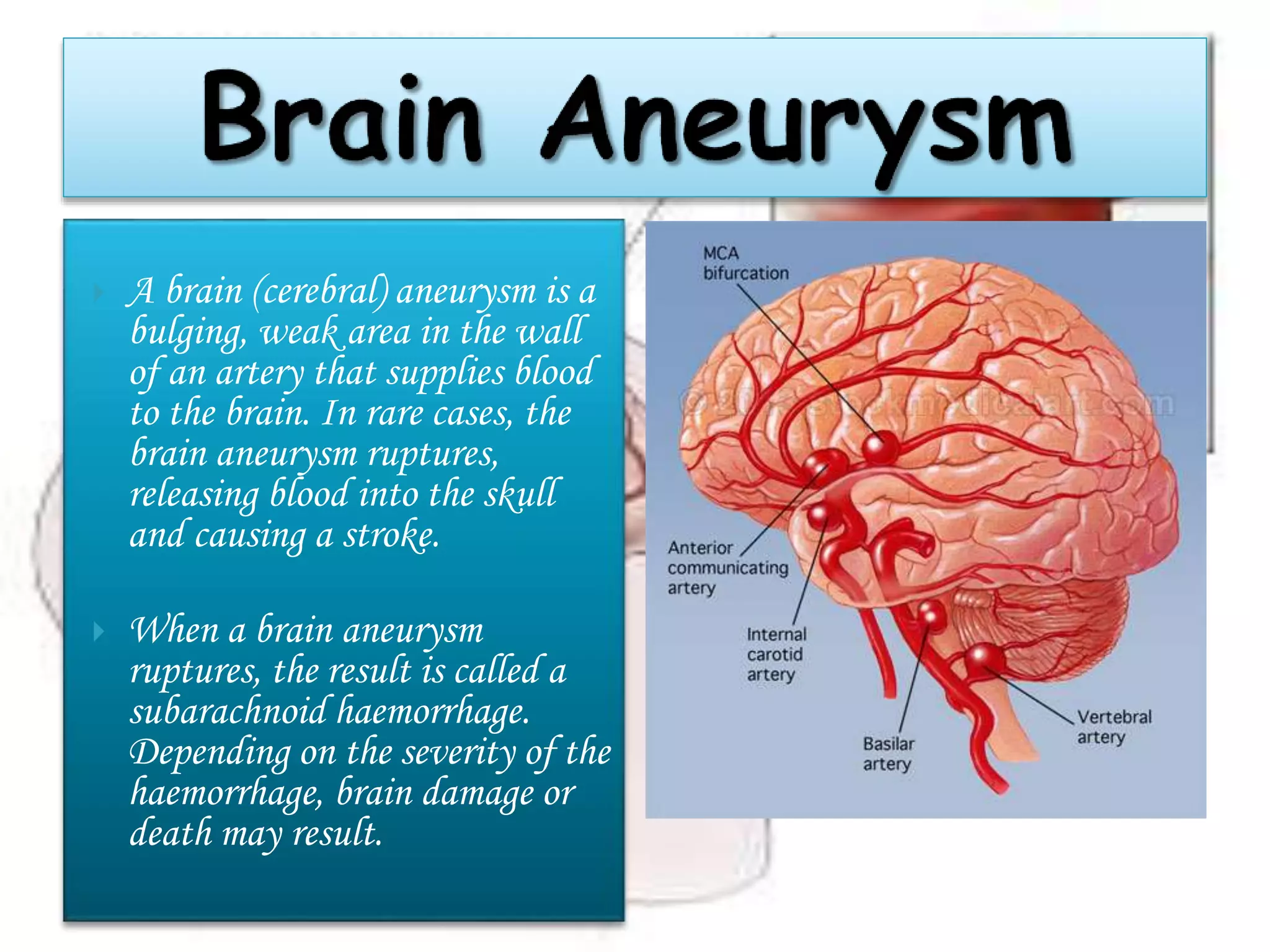 Brain aneurysm | PPTX