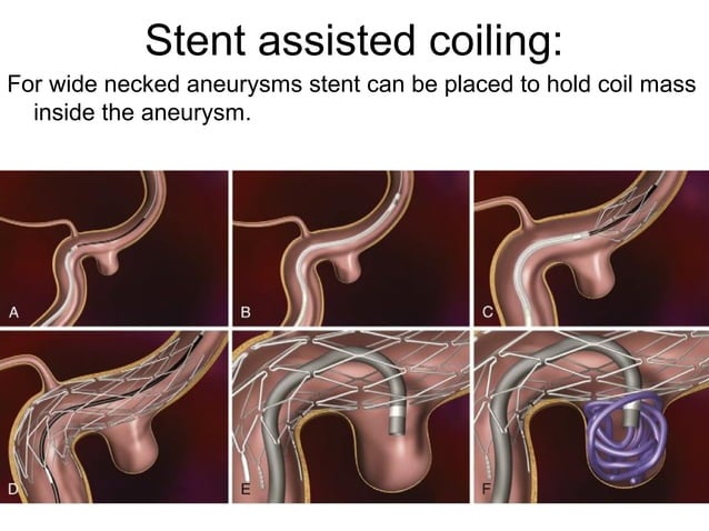 Brain aneurysm coiling | PPT | Brain and Nervous System Disorders ...