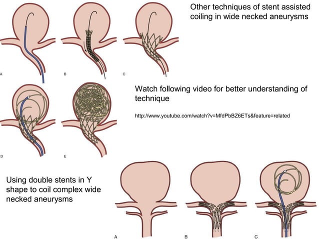 Brain aneurysm coiling | PPT | Brain and Nervous System Disorders ...