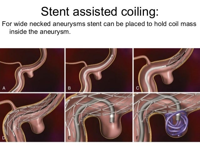 Brain aneurysm coiling