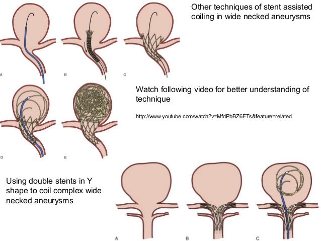 Brain aneurysm coiling