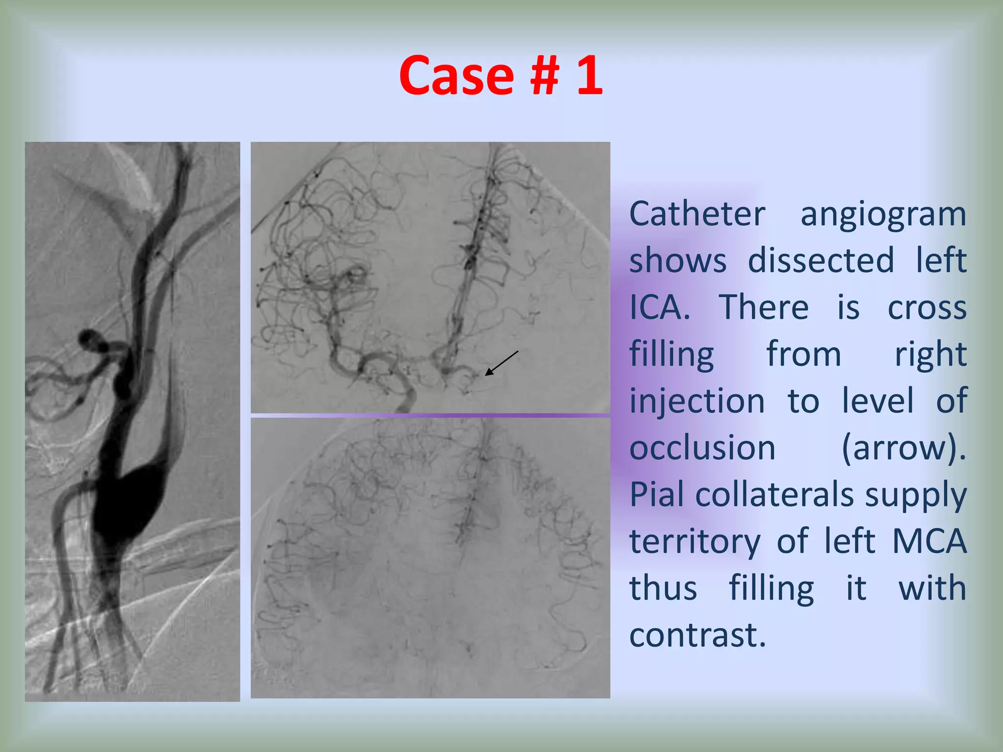 Brain angiography | PPTX