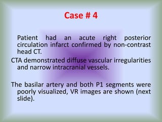 Brain angiography | PPTX