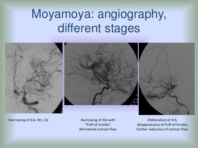 Brain angiography