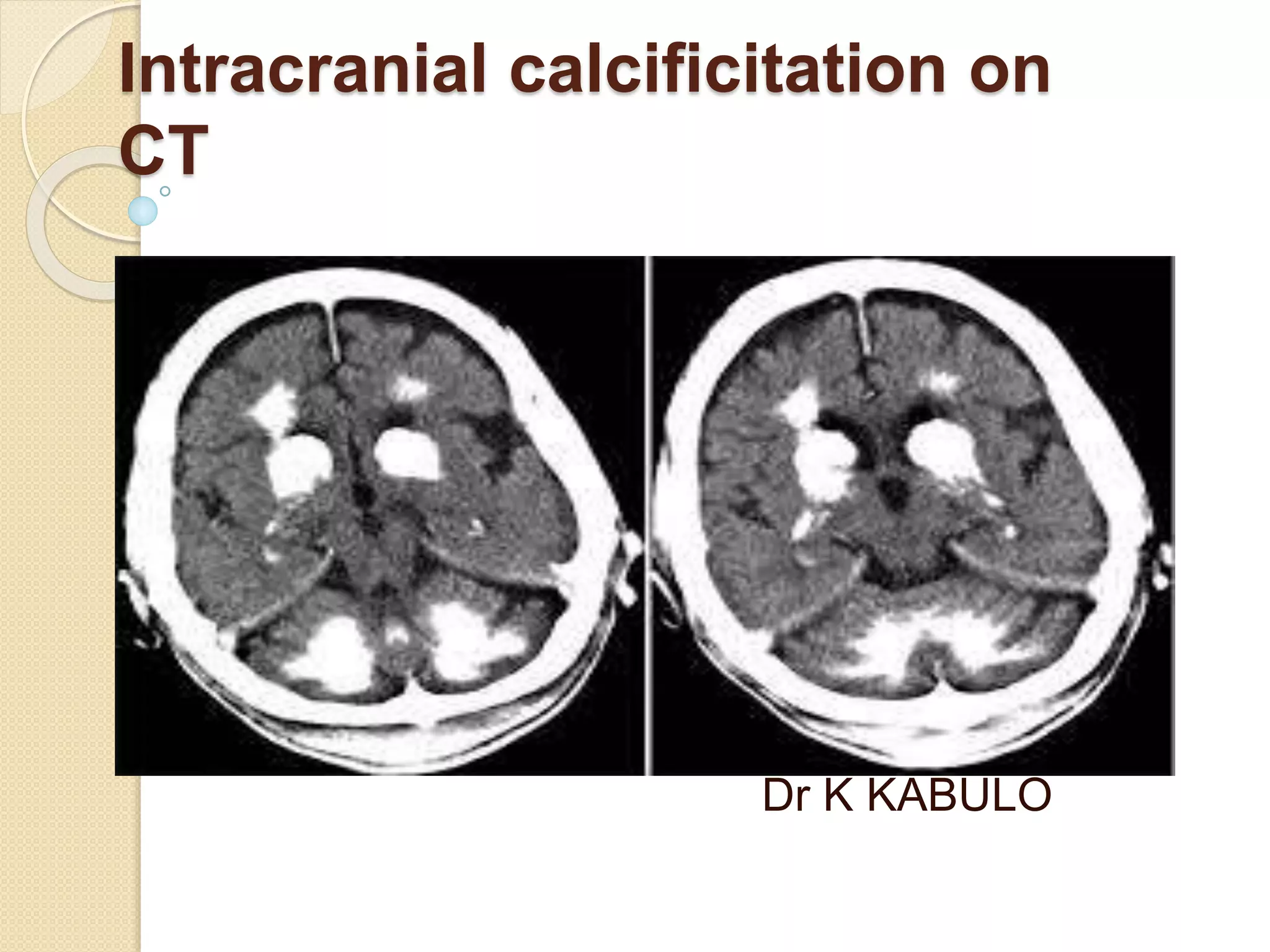 intracerebral calcification | PPTX