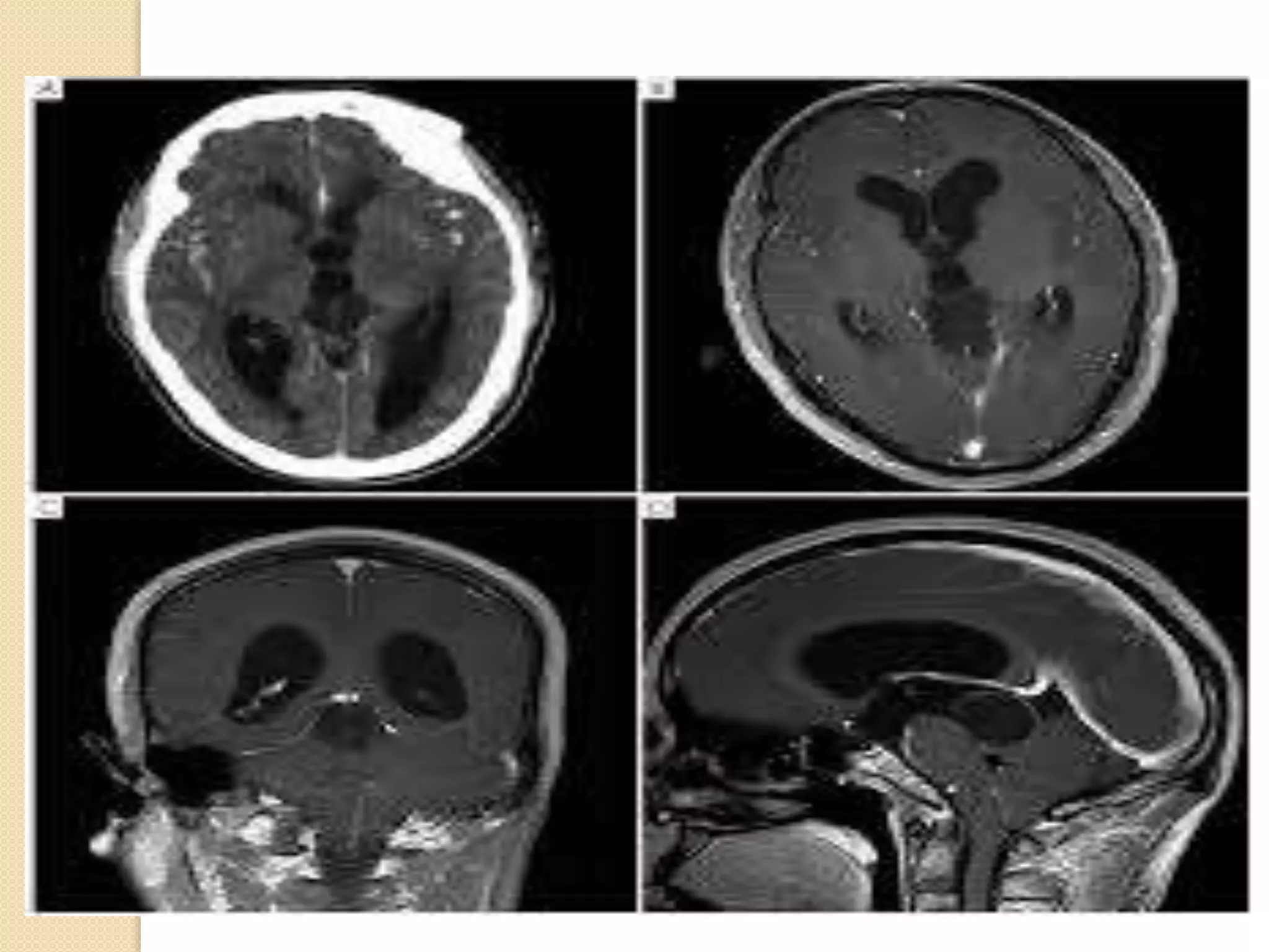 intracerebral calcification | PPT