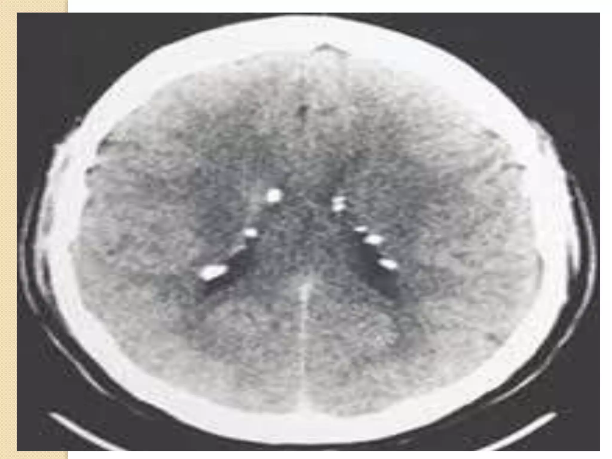 intracerebral calcification | PPTX