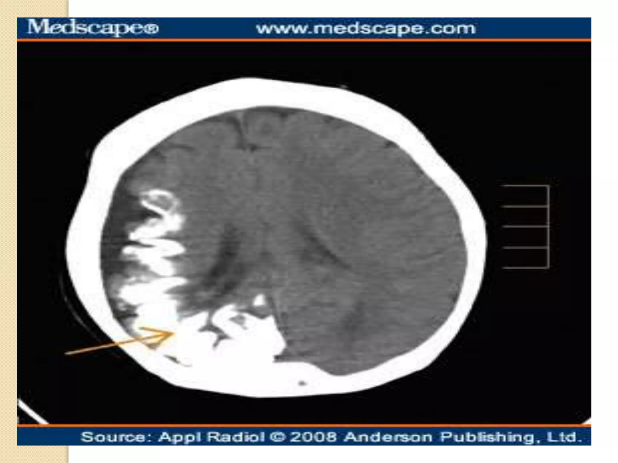 intracerebral calcification | PPTX
