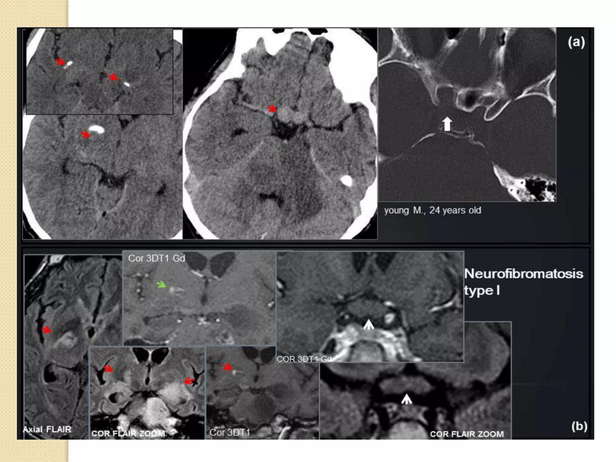 intracerebral calcification | PPTX