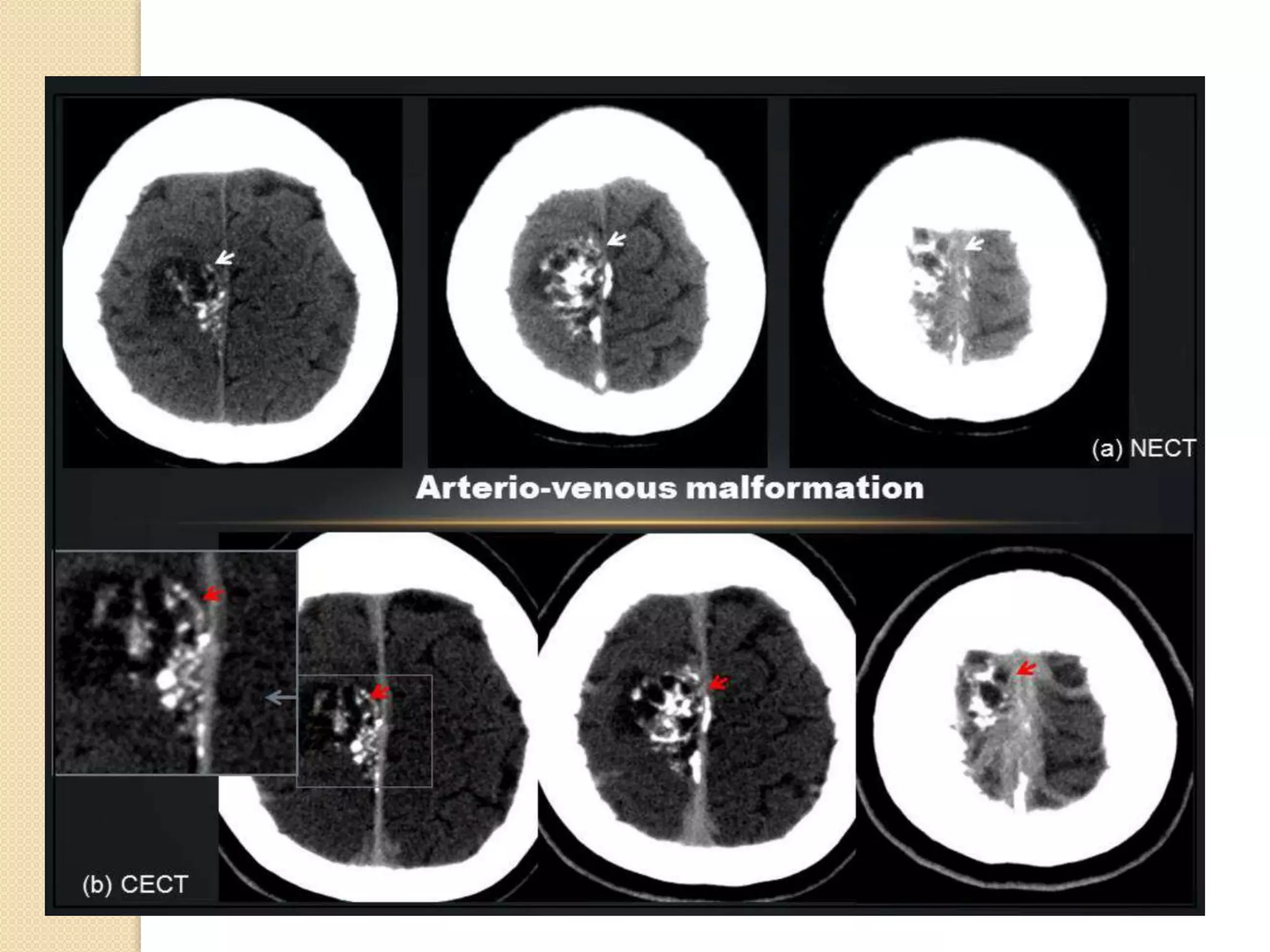intracerebral calcification | PPTX