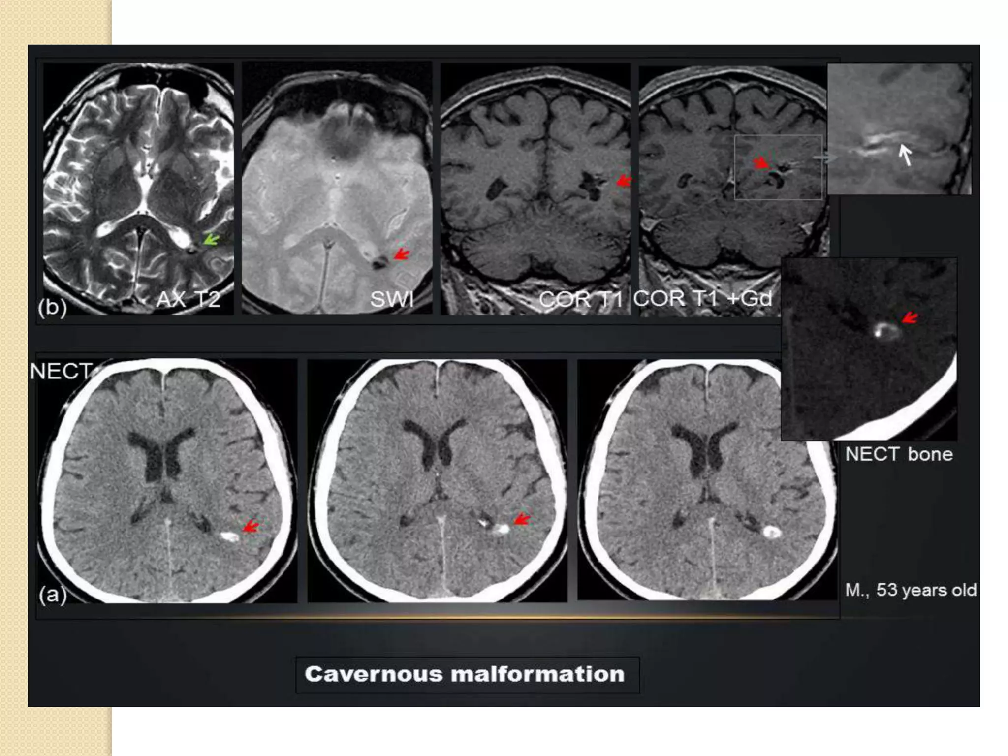 intracerebral calcification | PPT