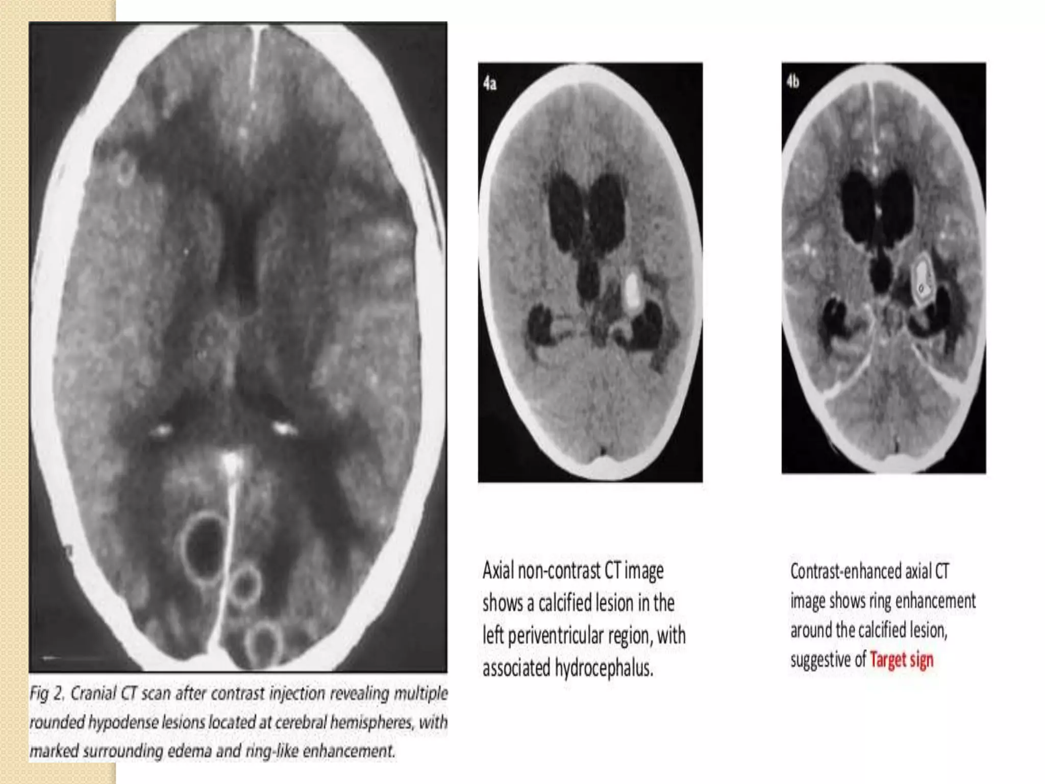 intracerebral calcification | PPTX