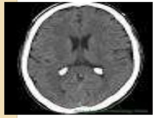 intracerebral calcification | PPTX