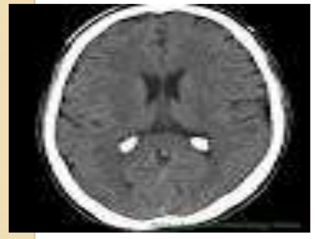 intracerebral calcification | PPTX | Brain and Nervous System Disorders ...