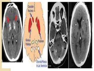 intracerebral calcification | PPTX