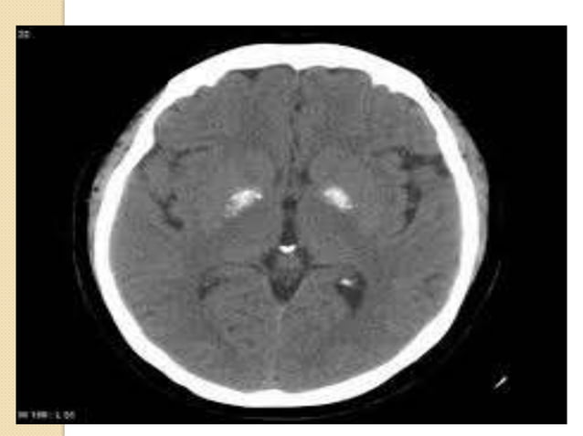 intracerebral calcification | PPTX | Brain and Nervous System Disorders ...