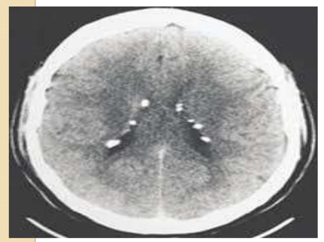 intracerebral calcification | PPTX | Brain and Nervous System Disorders ...