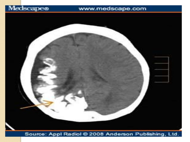 intracerebral calcification | PPTX | Brain and Nervous System Disorders ...