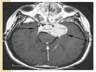 intracerebral calcification | PPTX