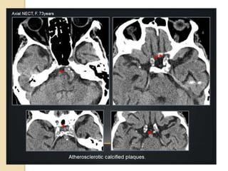 intracerebral calcification | PPTX
