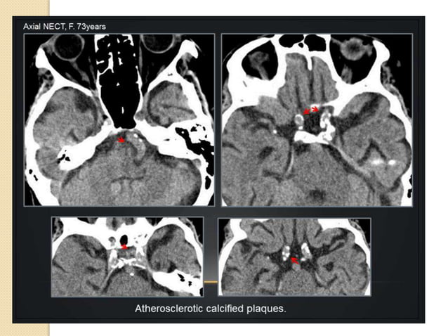 intracerebral calcification | PPTX | Brain and Nervous System Disorders ...