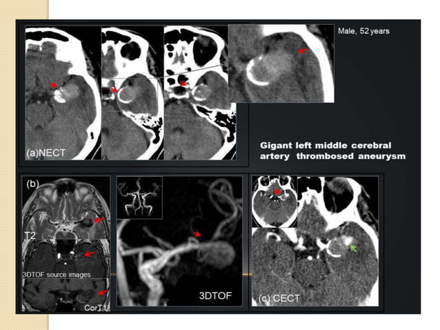 intracerebral calcification | PPTX | Brain and Nervous System Disorders ...