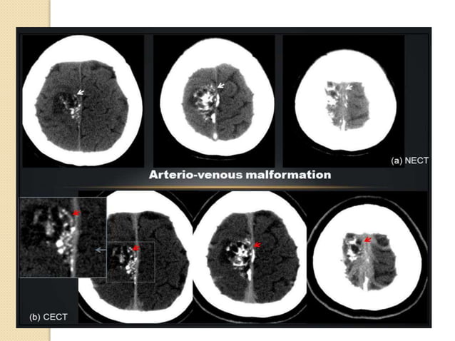 intracerebral calcification | PPTX | Brain and Nervous System Disorders ...