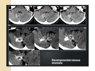 intracerebral calcification | PPTX