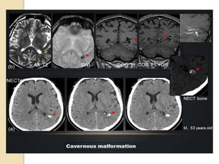 intracerebral calcification | PPTX