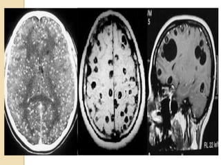 intracerebral calcification | PPTX