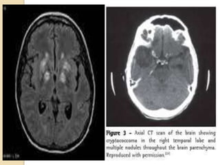 intracerebral calcification | PPTX