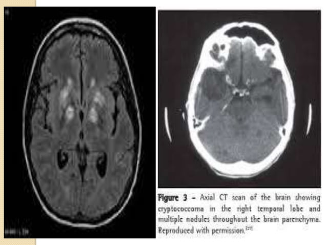intracerebral calcification | PPTX | Brain and Nervous System Disorders ...