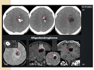 intracerebral calcification | PPTX