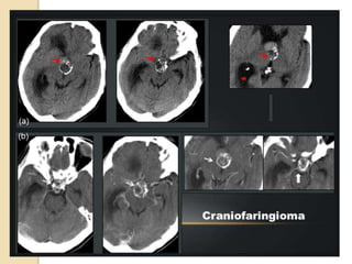 intracerebral calcification | PPTX