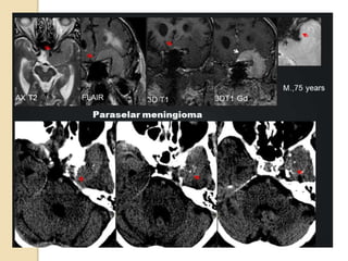 intracerebral calcification | PPTX